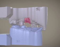 Implant 3D Printing Models | CGTrader