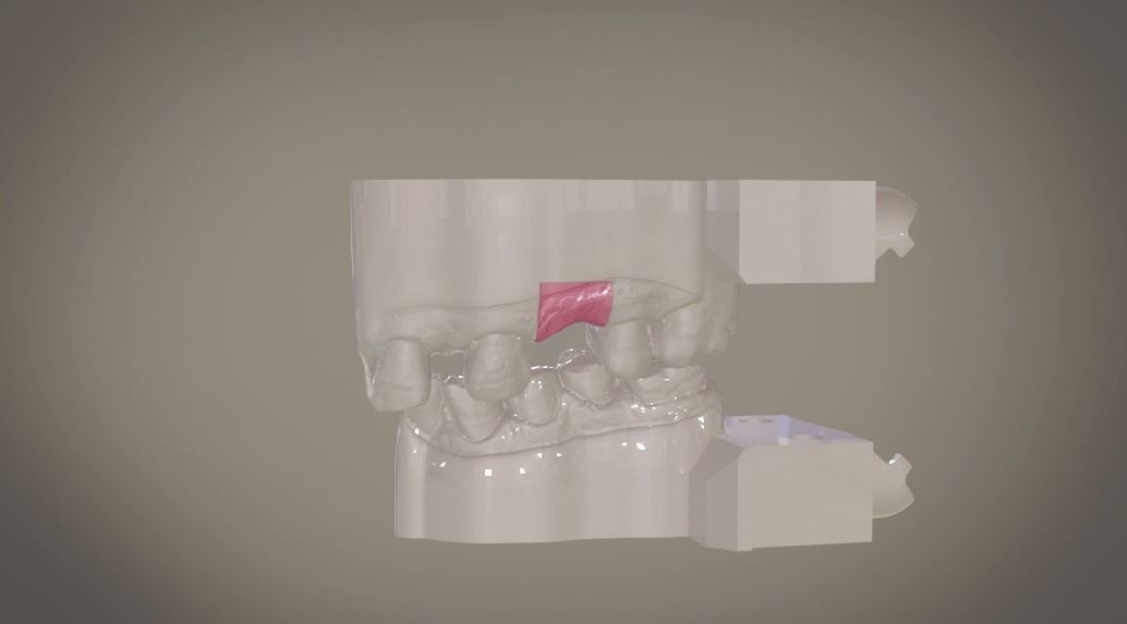Digital Implant Model with Soft Tissue 3D model 3D printable | CGTrader