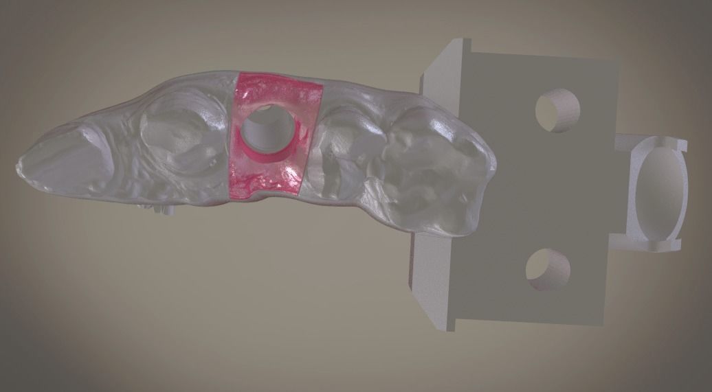 Digital Implant Model with Soft Tissue 3D model 3D printable | CGTrader